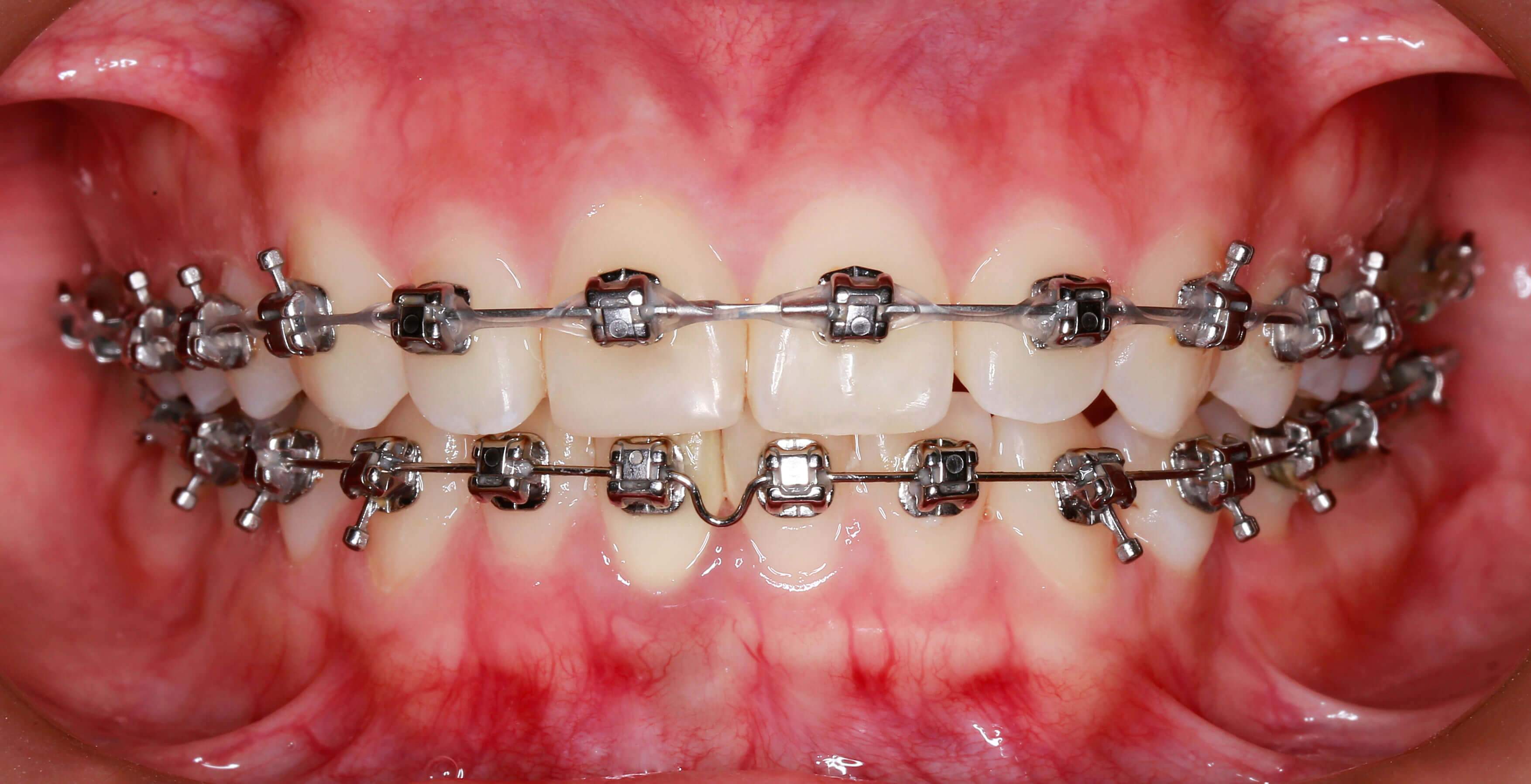 ORTHODONTICS | 3C Dental – SPECIALIZING IN BRACES